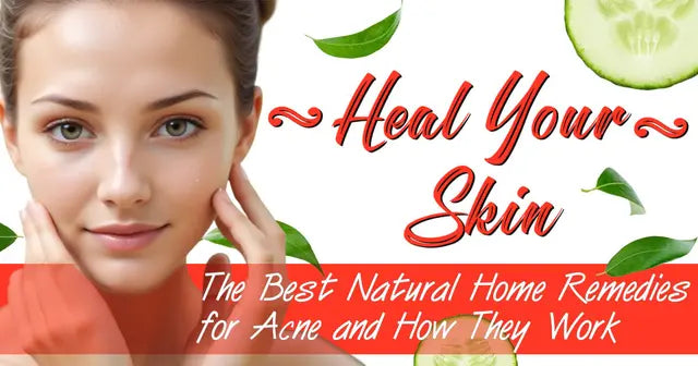 Heal Your Skin: The Best Natural Home Remedies for Acne and How They W ...